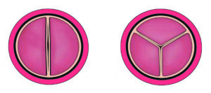 Aortic Valve Disease - Leeds Teaching Hospitals NHS Trust