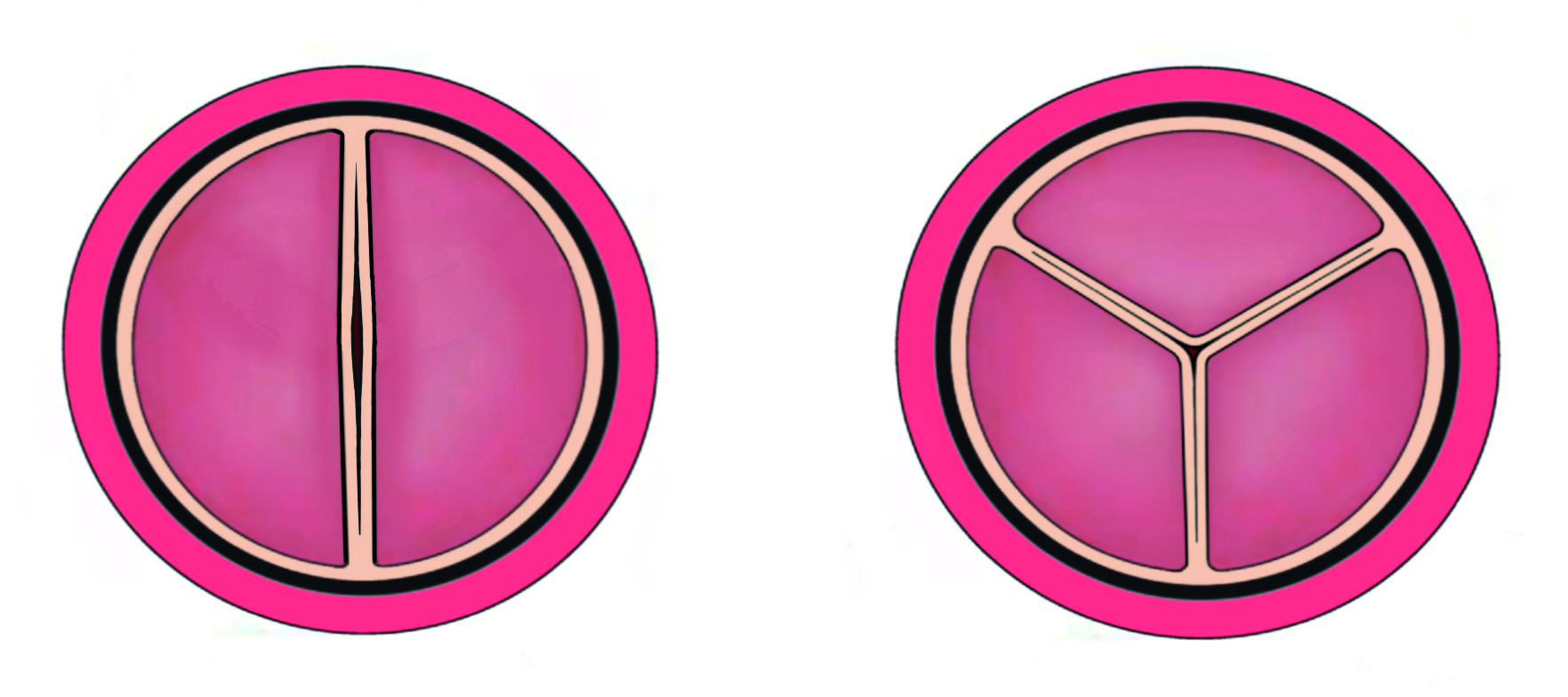 Aortic Valve Disease - Leeds Teaching Hospitals NHS Trust