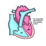 Congenitally Corrected Transposition of the Great Arteries (ccTGA ...