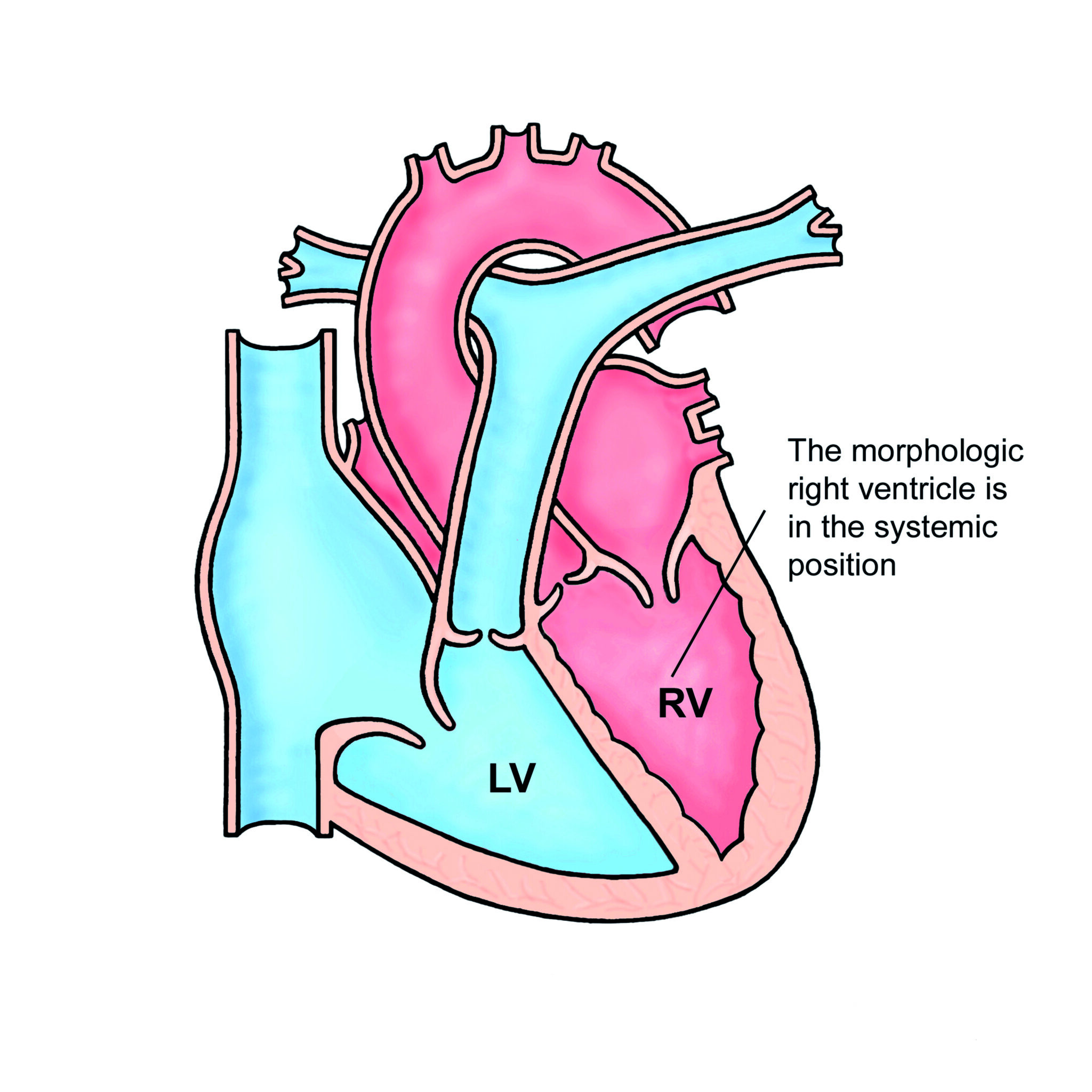 Congenitally Corrected Transposition of the Great Arteries (ccTGA ...