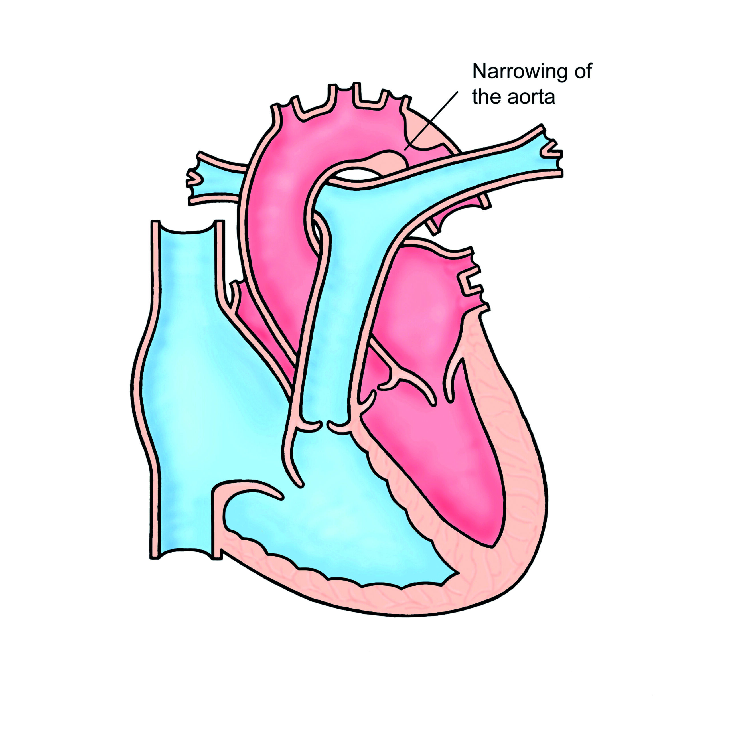 Transcatheter (keyhole) stent placement for Coarctation of the Aorta ...