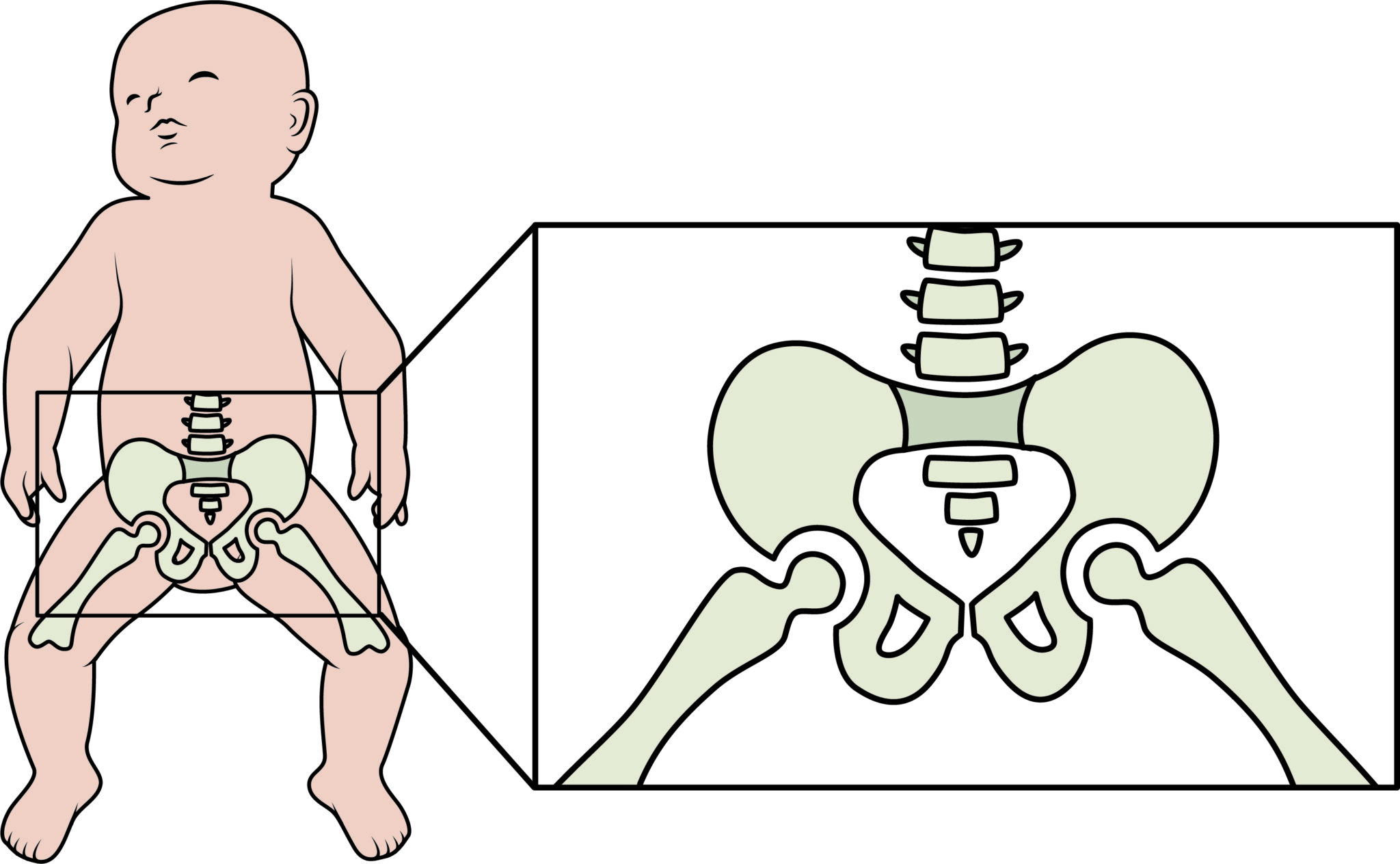 Developmental Dysplasia of the Hip - Leeds Teaching Hospitals NHS Trust