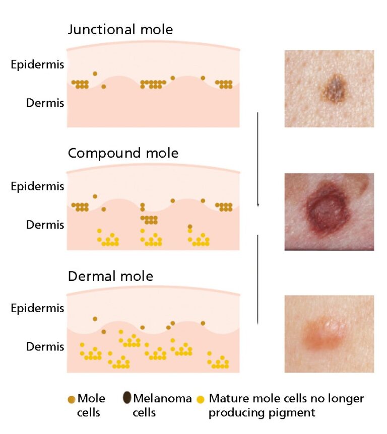 Looking after your moles - Leeds Teaching Hospitals NHS Trust