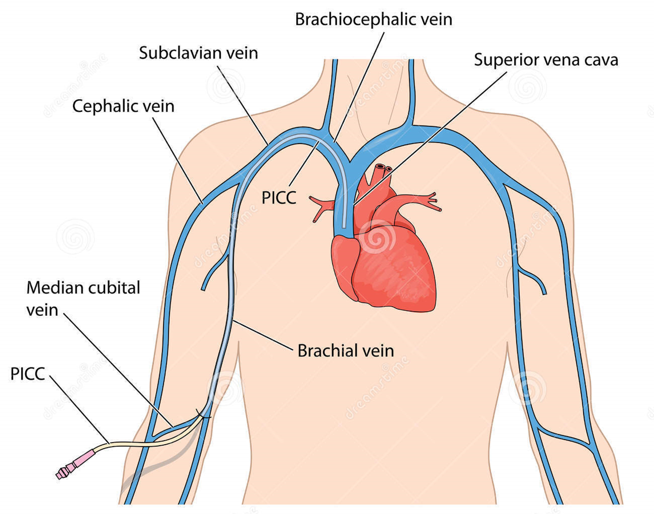 Hickman Catheter Vs Picc Line
