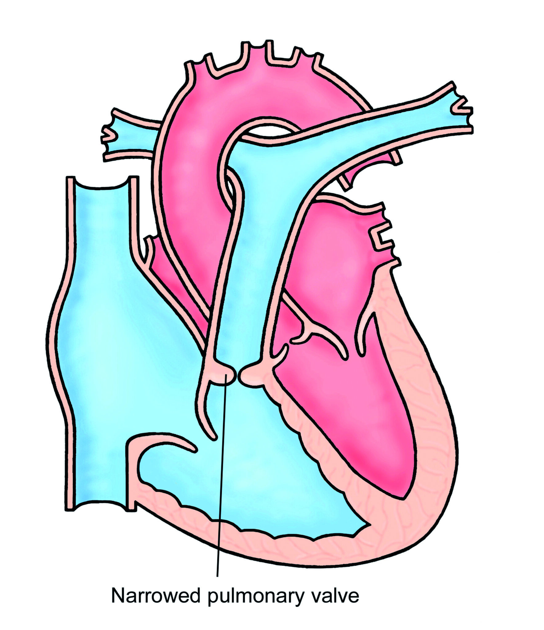 Transcatheter Pulmonary Valve Replacement - Leeds Teaching Hospitals ...