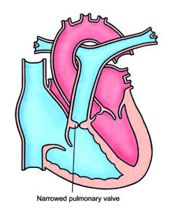 Transcatheter Pulmonary Valve Replacement - Leeds Teaching Hospitals ...