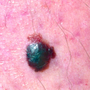 What is Melanoma? - Leeds Teaching Hospitals NHS Trust