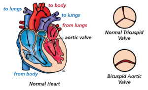 Bicuspid Aortic Valve - Leeds Teaching Hospitals NHS Trust