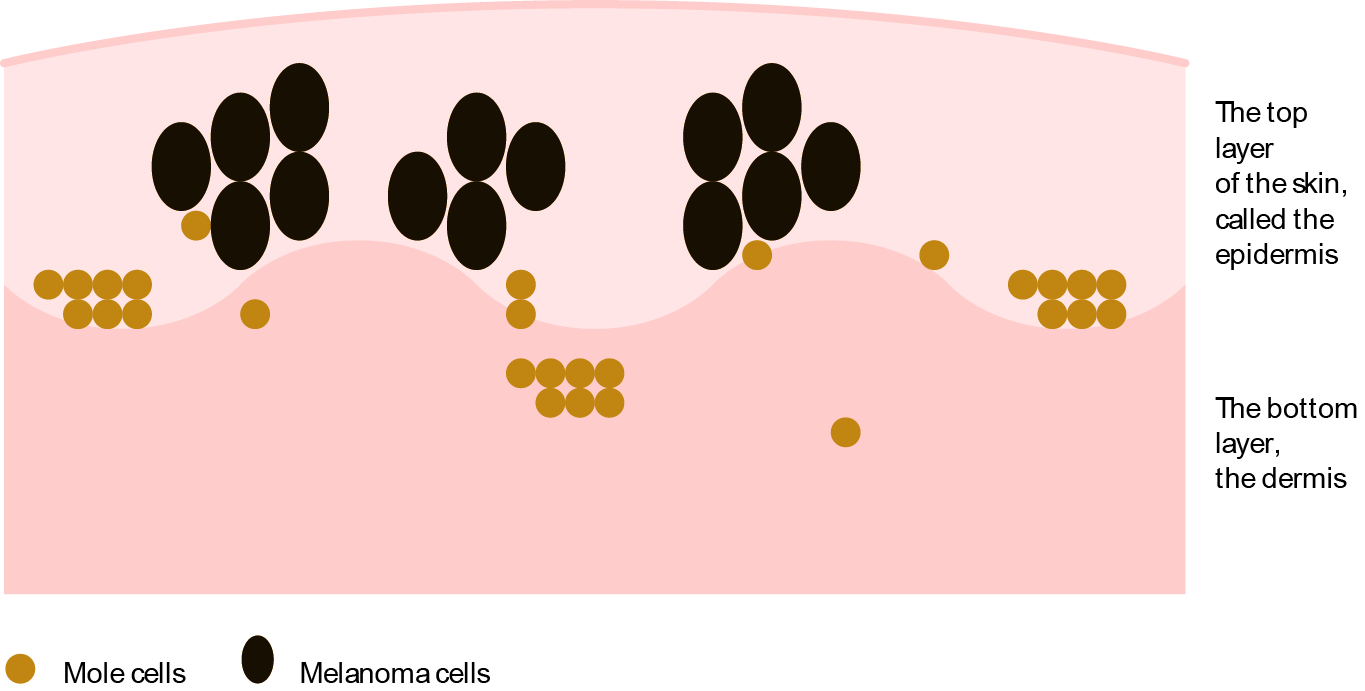 What is Melanoma? - Leeds Teaching Hospitals NHS Trust