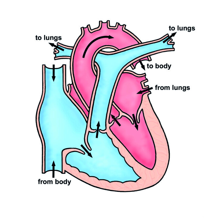 Atrial Septal Defect - percutaneous (keyhole) closure - Leeds Teaching ...