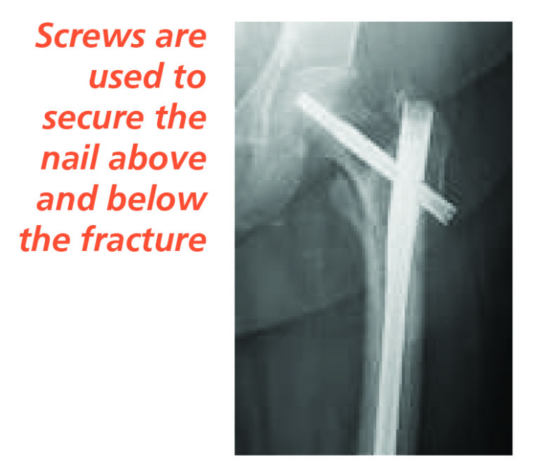 Recovering from a hip fracture - Leeds Teaching Hospitals NHS Trust