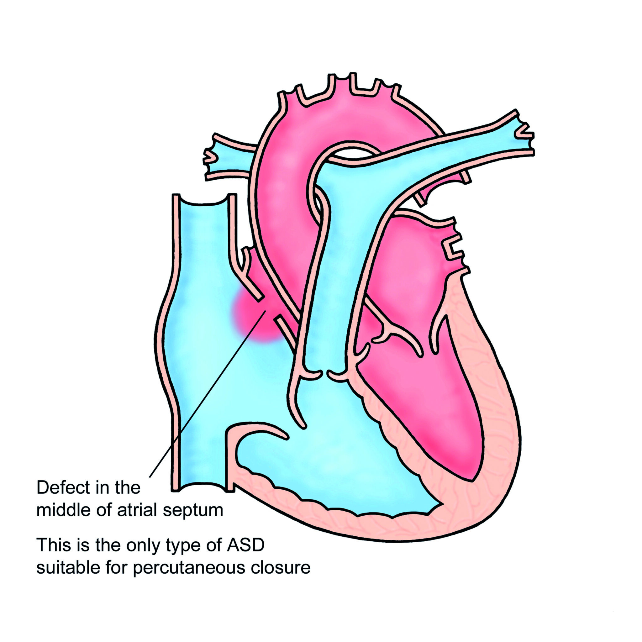 Atrial Septal Defect - percutaneous (keyhole) closure - Leeds Teaching ...