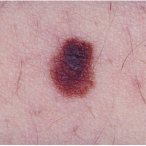 What is Melanoma? - Leeds Teaching Hospitals NHS Trust