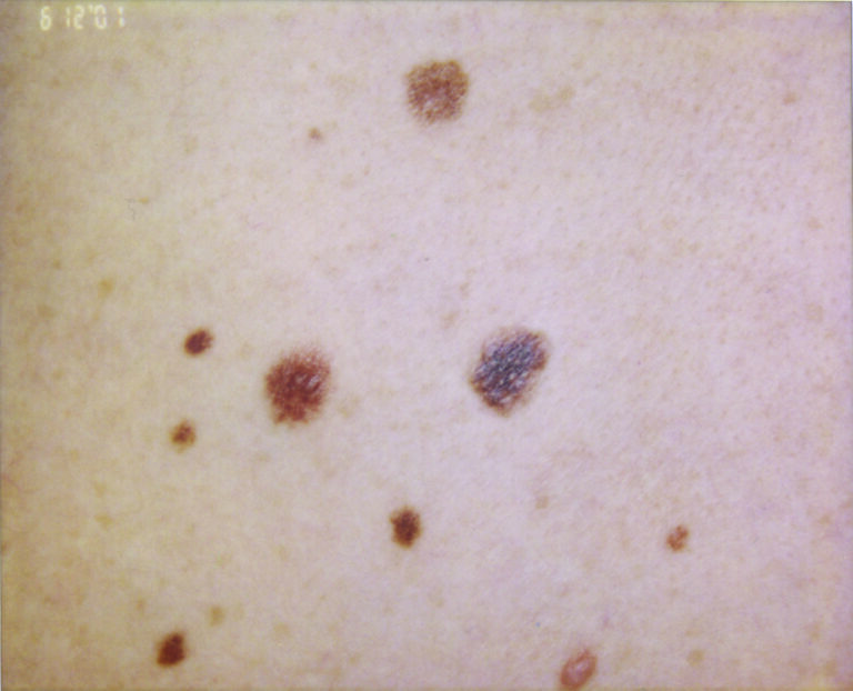 What is Melanoma? - Leeds Teaching Hospitals NHS Trust
