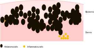 What is Melanoma? - Leeds Teaching Hospitals NHS Trust