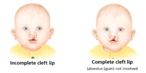 Cleft Lip - Leeds Teaching Hospitals NHS Trust