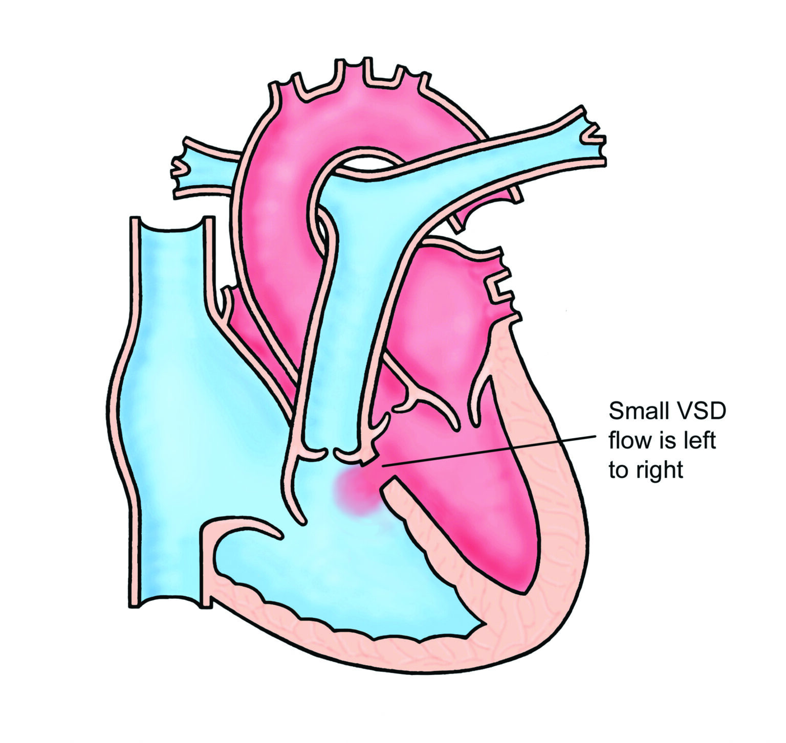 Small Ventricular Septal Defect (Perimembranous) - Leeds Teaching ...