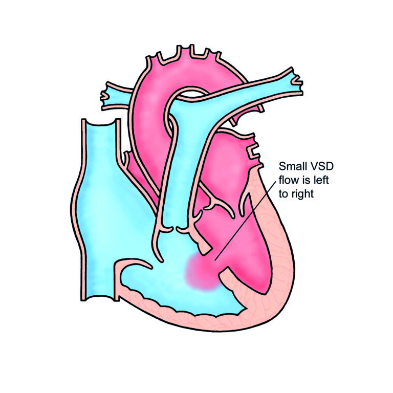 Ventricular Septal Defect (VSD) - Leeds Teaching Hospitals NHS Trust