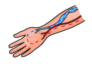 What is a Fistula? - Leeds Teaching Hospitals NHS Trust