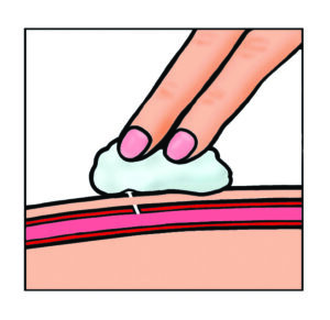 Fistula Care - Leeds Teaching Hospitals NHS Trust