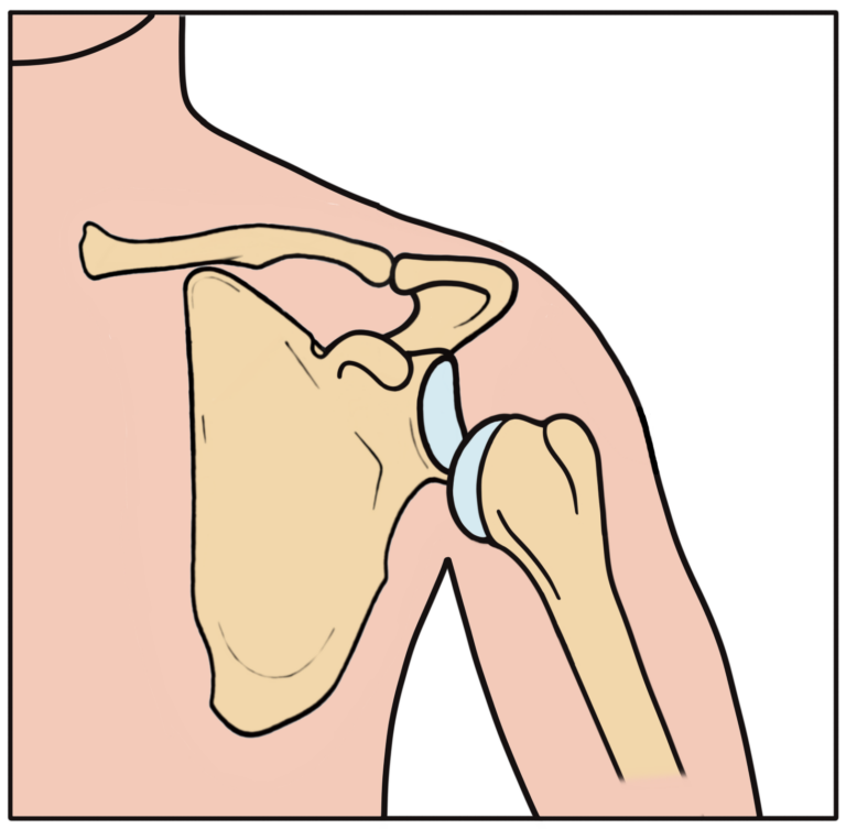 Anterior shoulder dislocation without bony injury - Leeds Teaching ...
