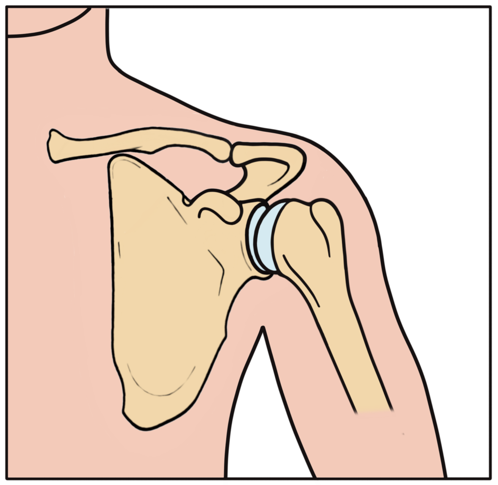 Anterior shoulder dislocation without bony injury - Leeds Teaching ...