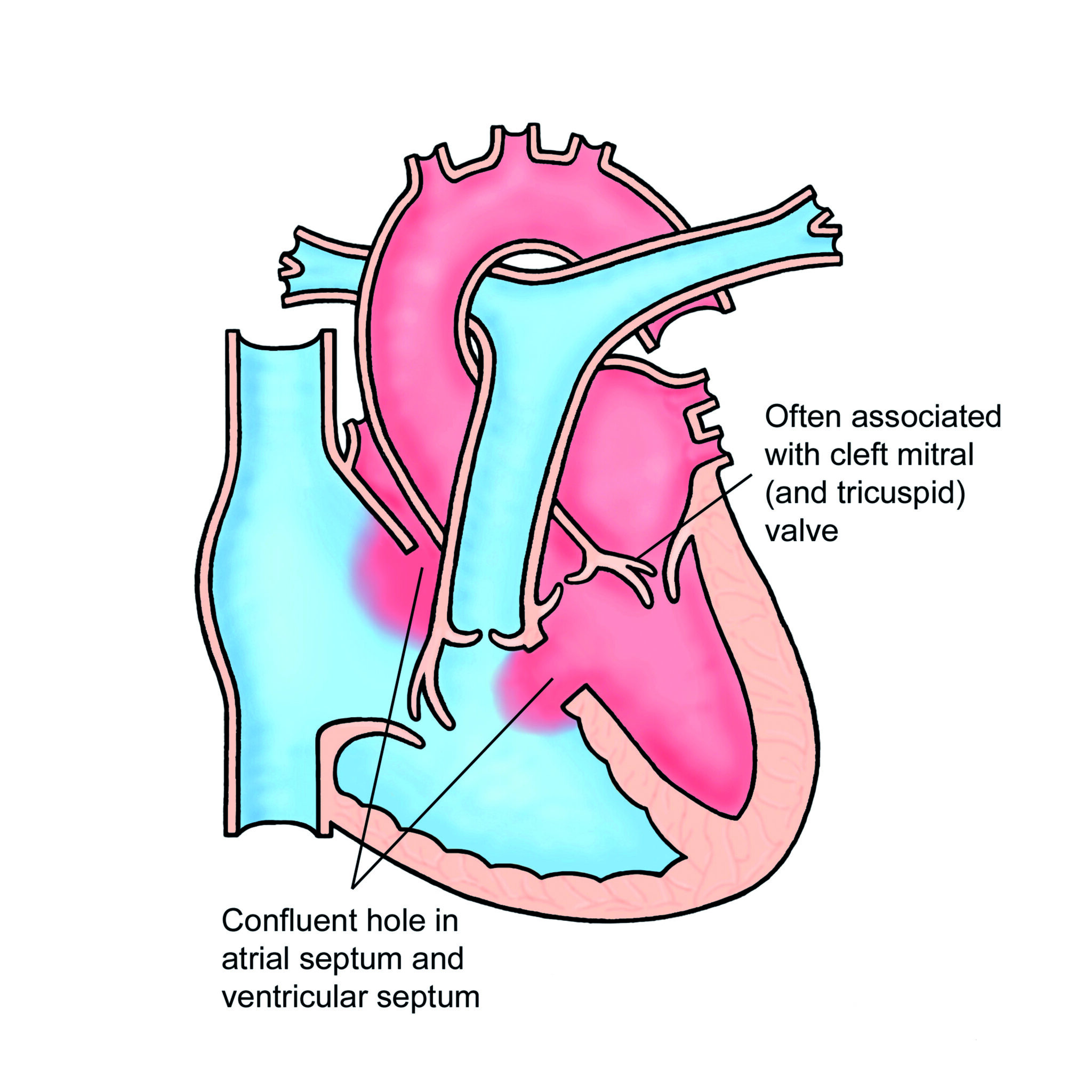Complete Atrioventricular Septal Defect in children - Leeds Teaching ...