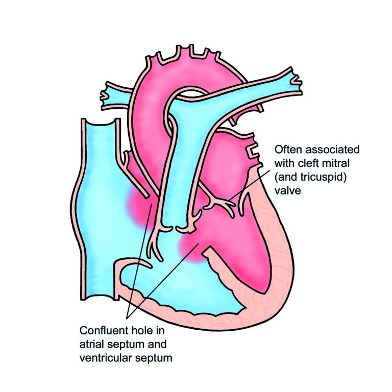 Complete Atrioventricular Septal Defect in children - Leeds Teaching ...