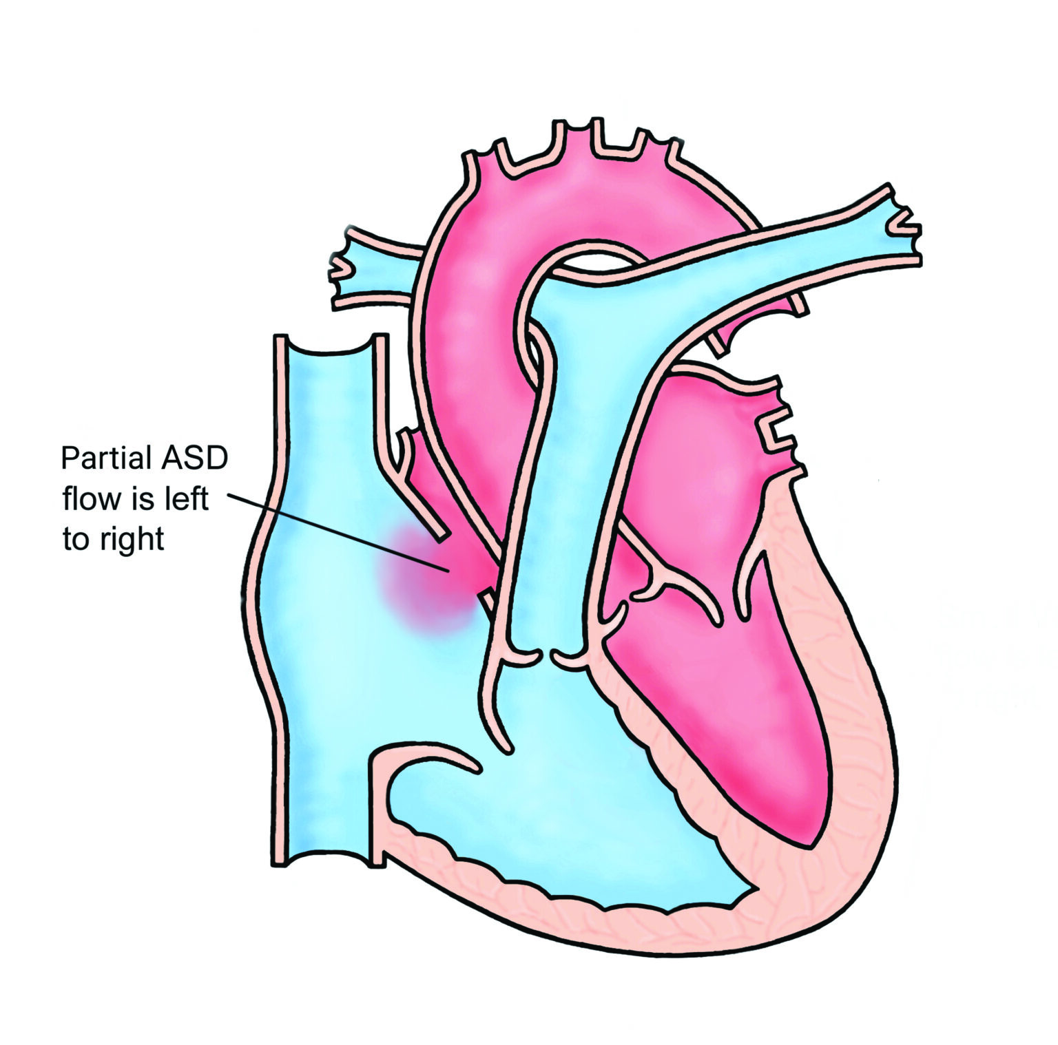 Partial Atrio-Ventricular Septal Defect in children - Leeds Teaching ...