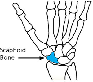 Suspected Scaphoid Fracture Advice - Leeds Teaching Hospitals NHS Trust
