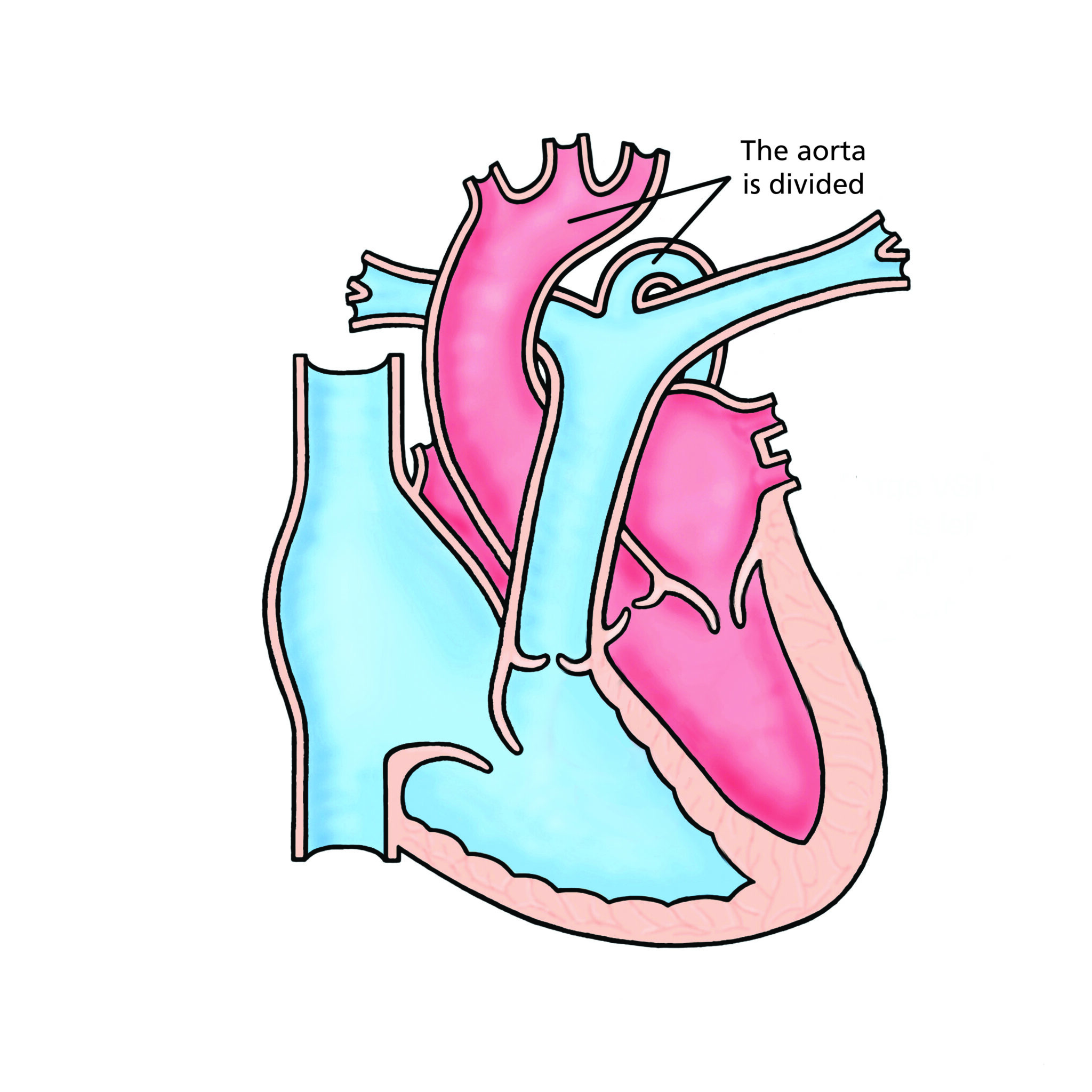 Interrupted Aortic Arch in children - Leeds Teaching Hospitals NHS Trust