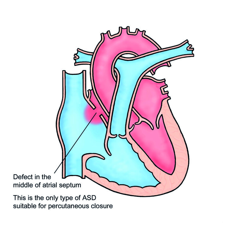 Atrial Septal Defect in children - Leeds Teaching Hospitals NHS Trust