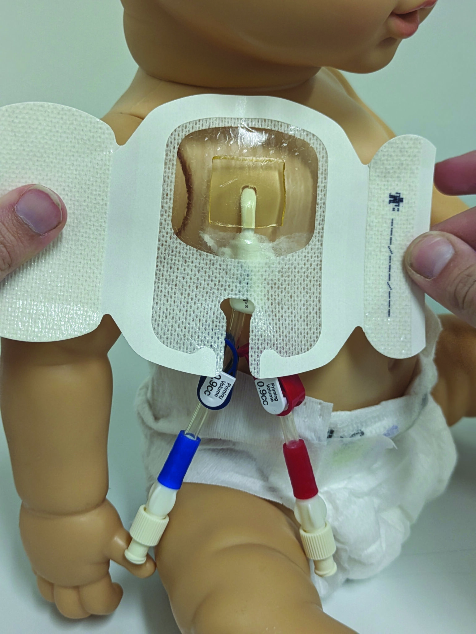 Haemodialysis Line (Permcath) - Leeds Teaching Hospitals NHS Trust