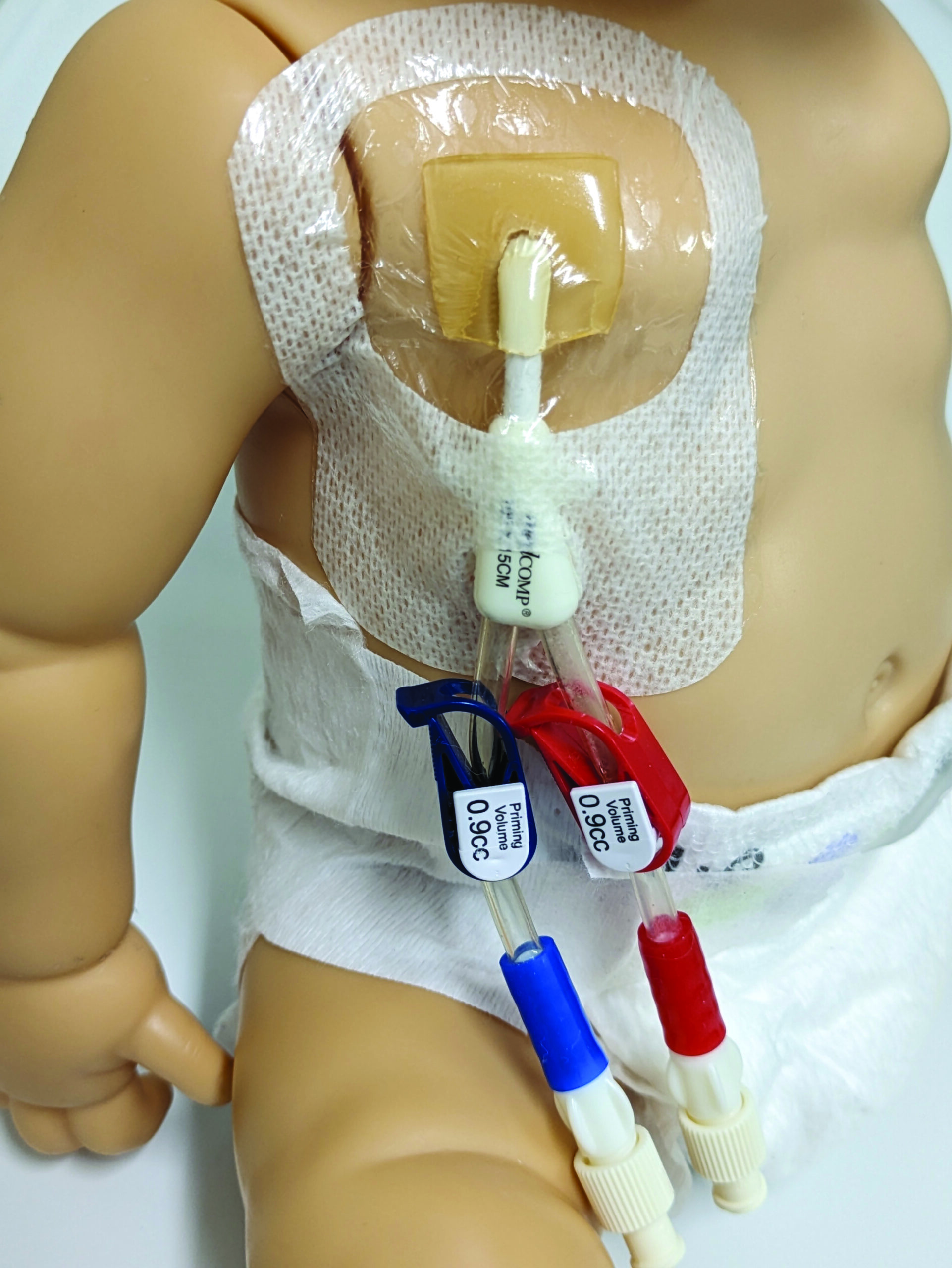 Haemodialysis Line (Permcath) - Leeds Teaching Hospitals NHS Trust