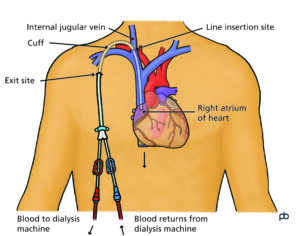 Haemodialysis Line (Permcath) - Leeds Teaching Hospitals NHS Trust