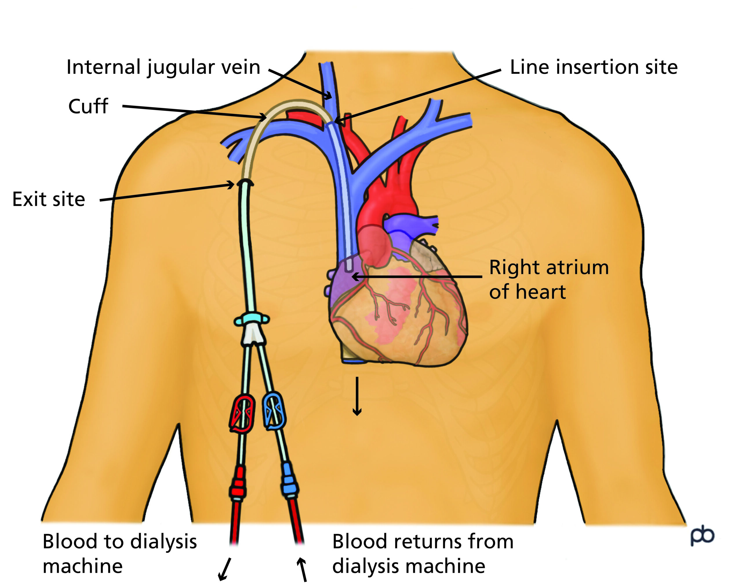 The Quinton Permcath Dialysis Catheter Download The Quinton Permcath