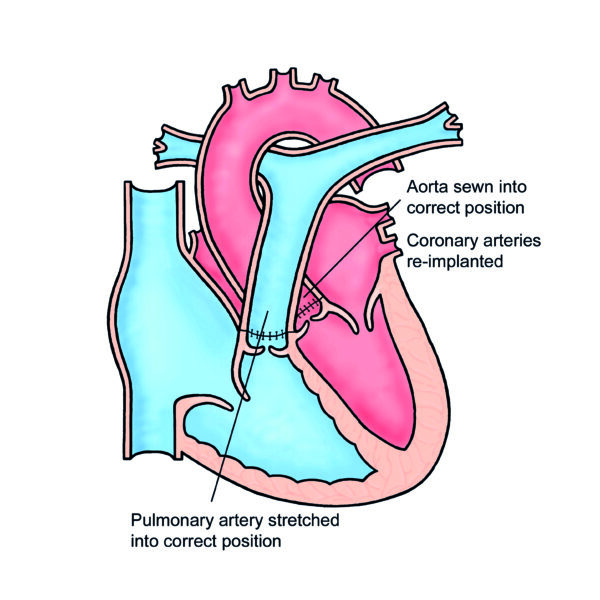 Transposition of the great arteries - Arterial Switch - Leeds Teaching ...