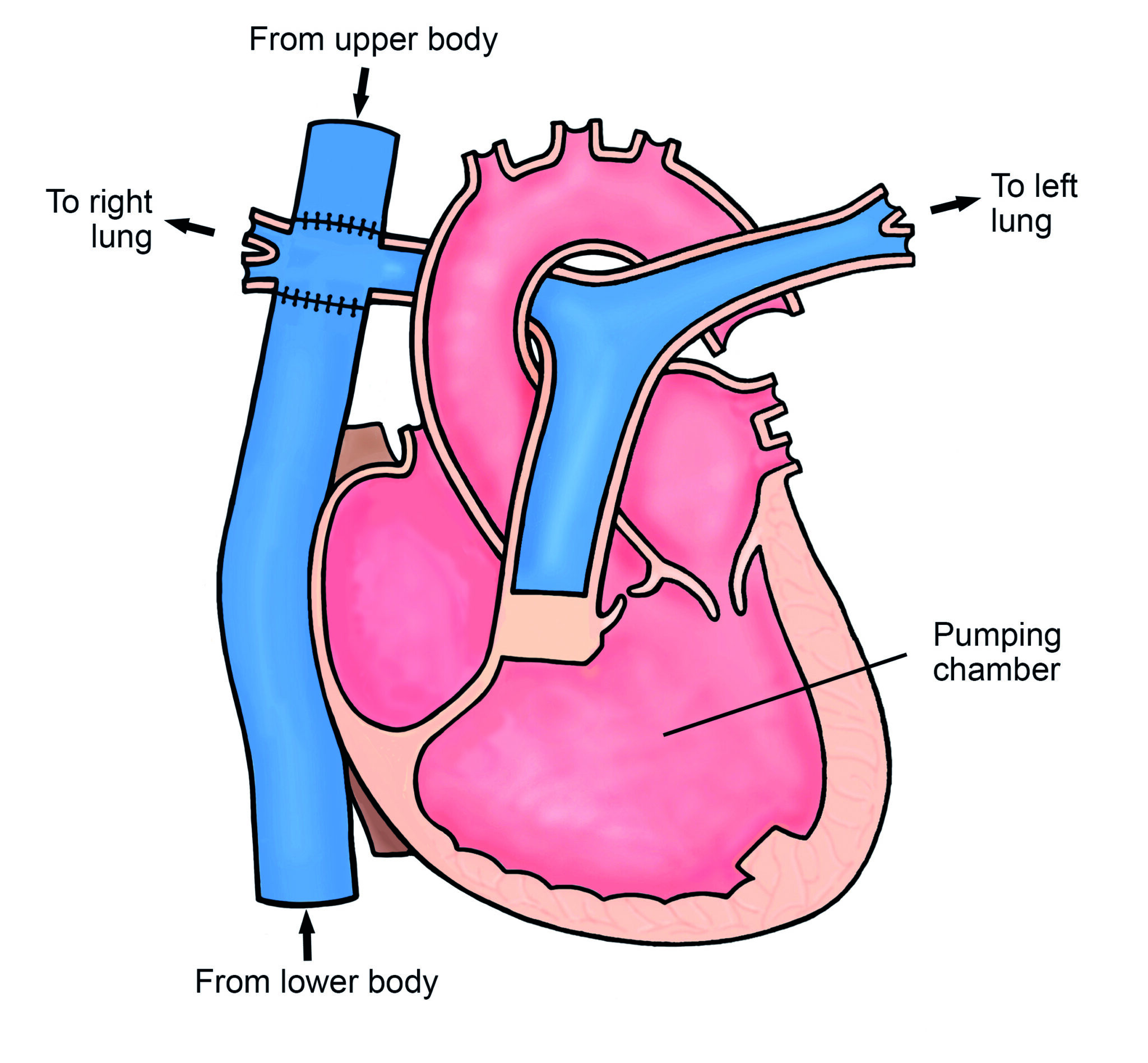 Fontan Circulation - Leeds Teaching Hospitals NHS Trust