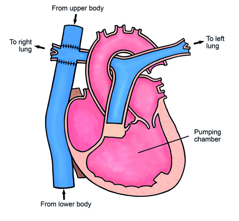 Fontan Circulation - Leeds Teaching Hospitals NHS Trust