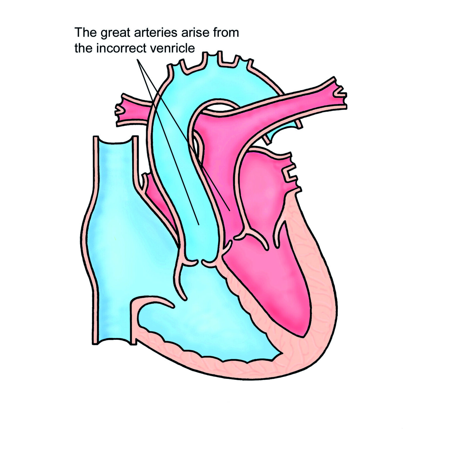 Transposition of the great arteries - Arterial Switch - Leeds Teaching ...