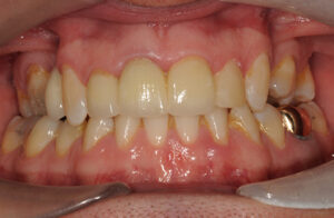 Crowns - Leeds Teaching Hospitals NHS Trust