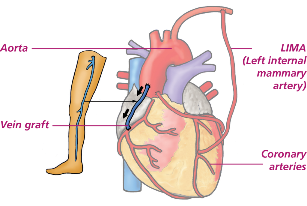 Your journey through heart surgery - Leeds Teaching Hospitals NHS Trust
