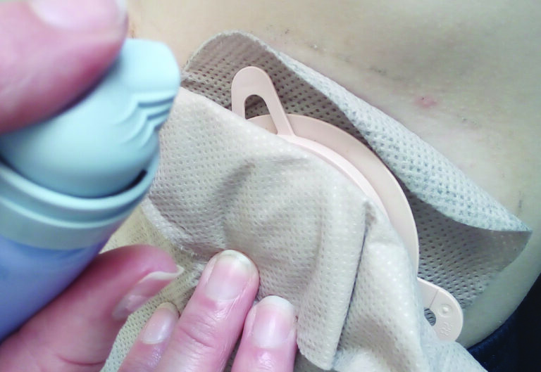 Paediatric step by step procedure for a 2 piece stoma bag change ...