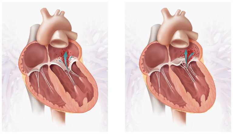 Mitral Valve Transcatheter Edge-to-Edge Repair (TEER) - Leeds Teaching ...
