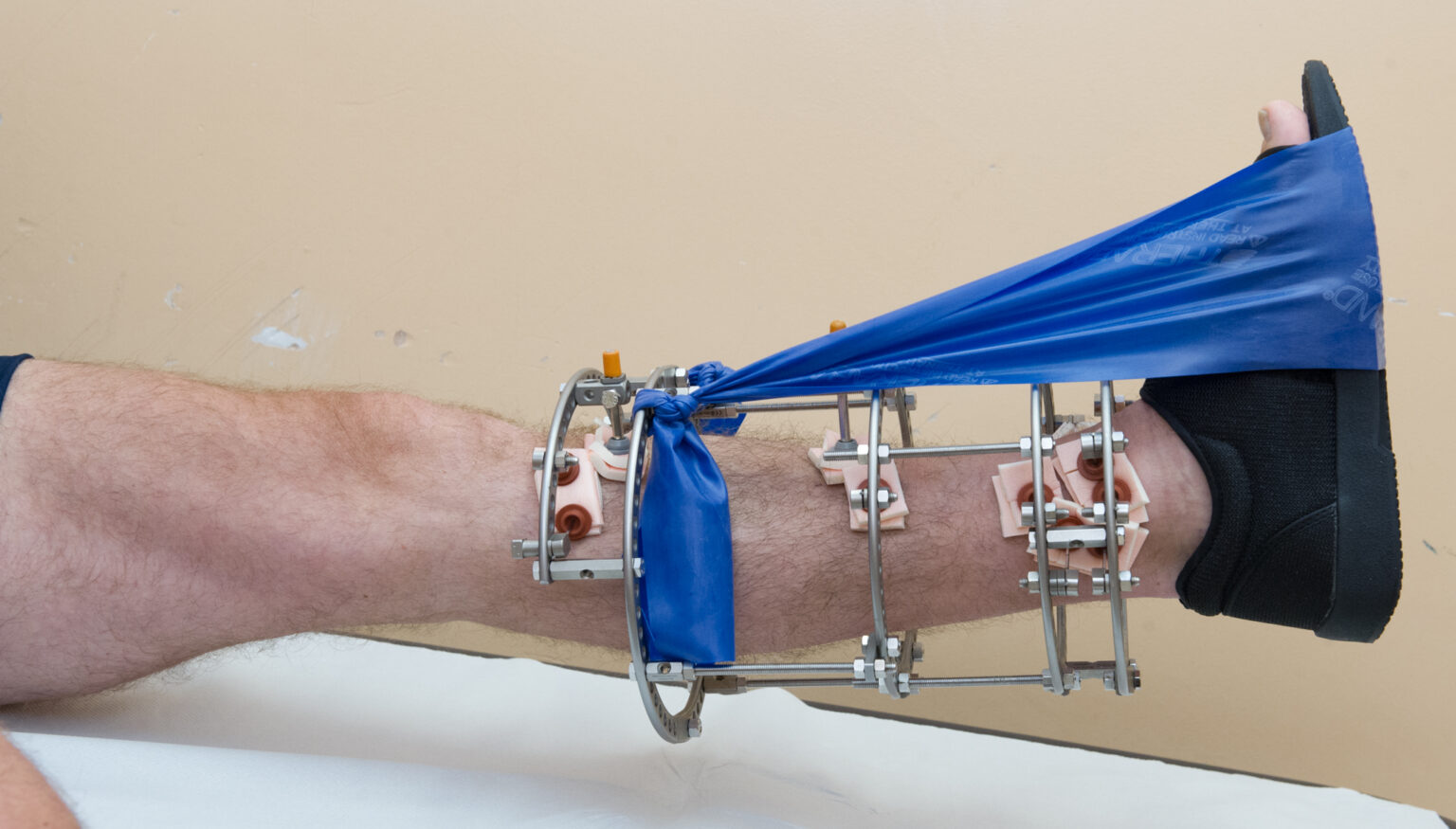 Having an External Fixation Device - Adults - Leeds Teaching Hospitals ...