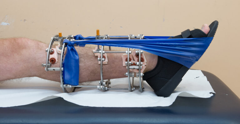 Having an External Fixation Device - Adults - Leeds Teaching Hospitals ...