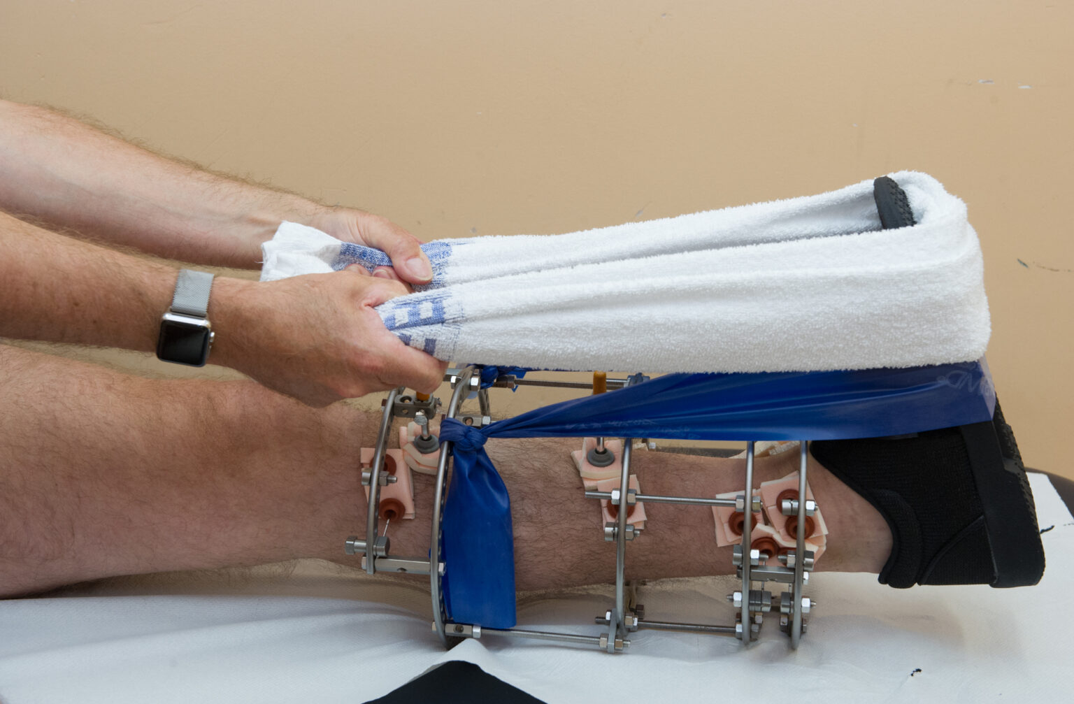 Having an External Fixation Device - Adults - Leeds Teaching Hospitals ...