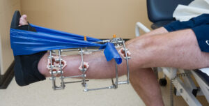 Having an External Fixation Device - Adults - Leeds Teaching Hospitals ...