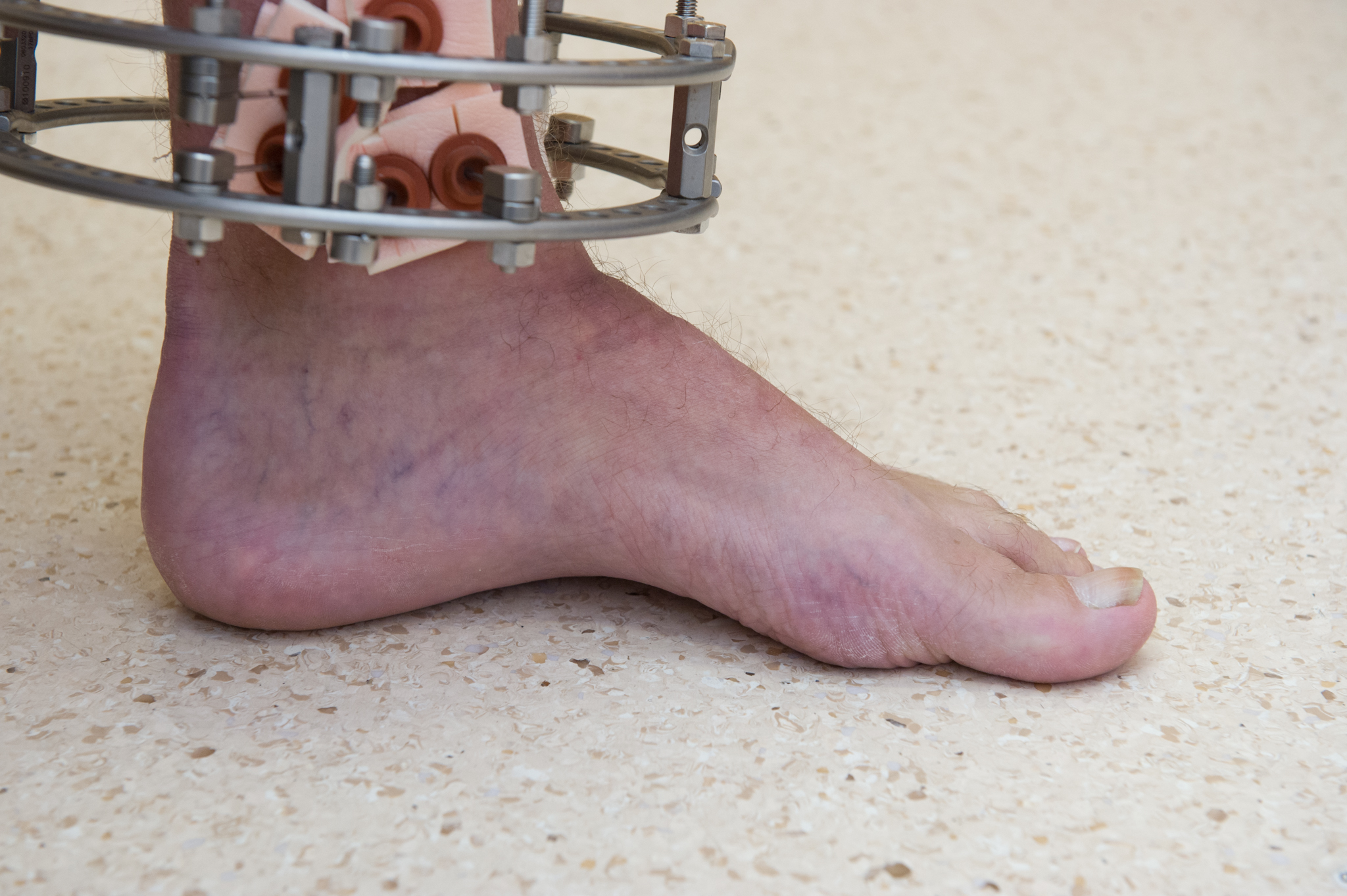 Having an External Fixation Device - Adults - Leeds Teaching Hospitals ...