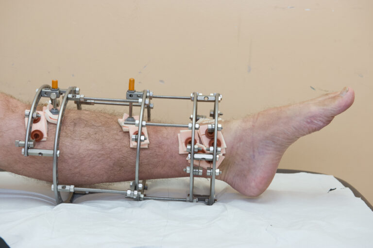 Having an External Fixation Device - Adults - Leeds Teaching Hospitals ...